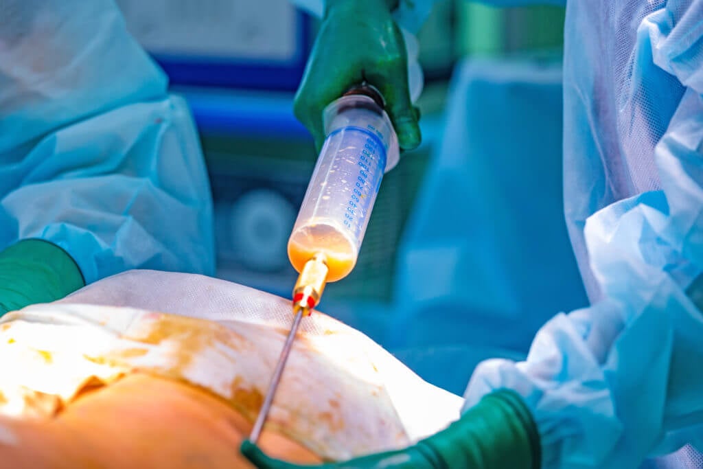 Is Laser Used When Getting an AirSculpt? – Fat Procedures